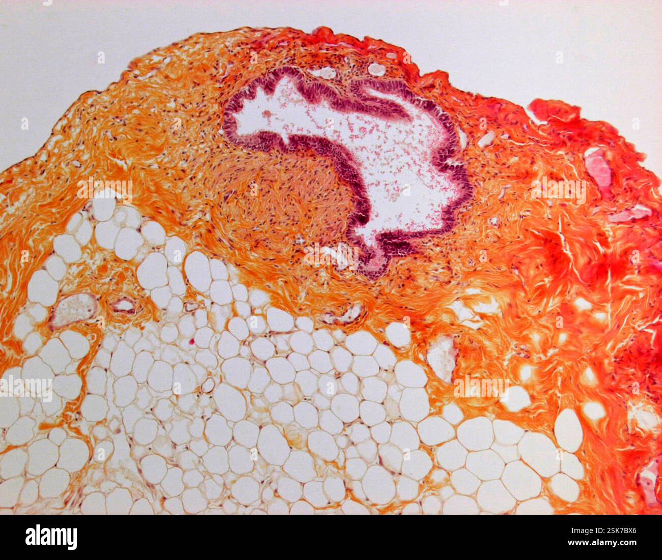 Endometriosis of the peritoneum. Light micrograph of a section through ...