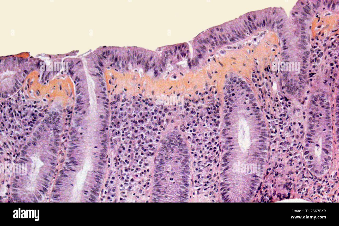 Collagenous colitis. Light micrograph of a section through a colon ...