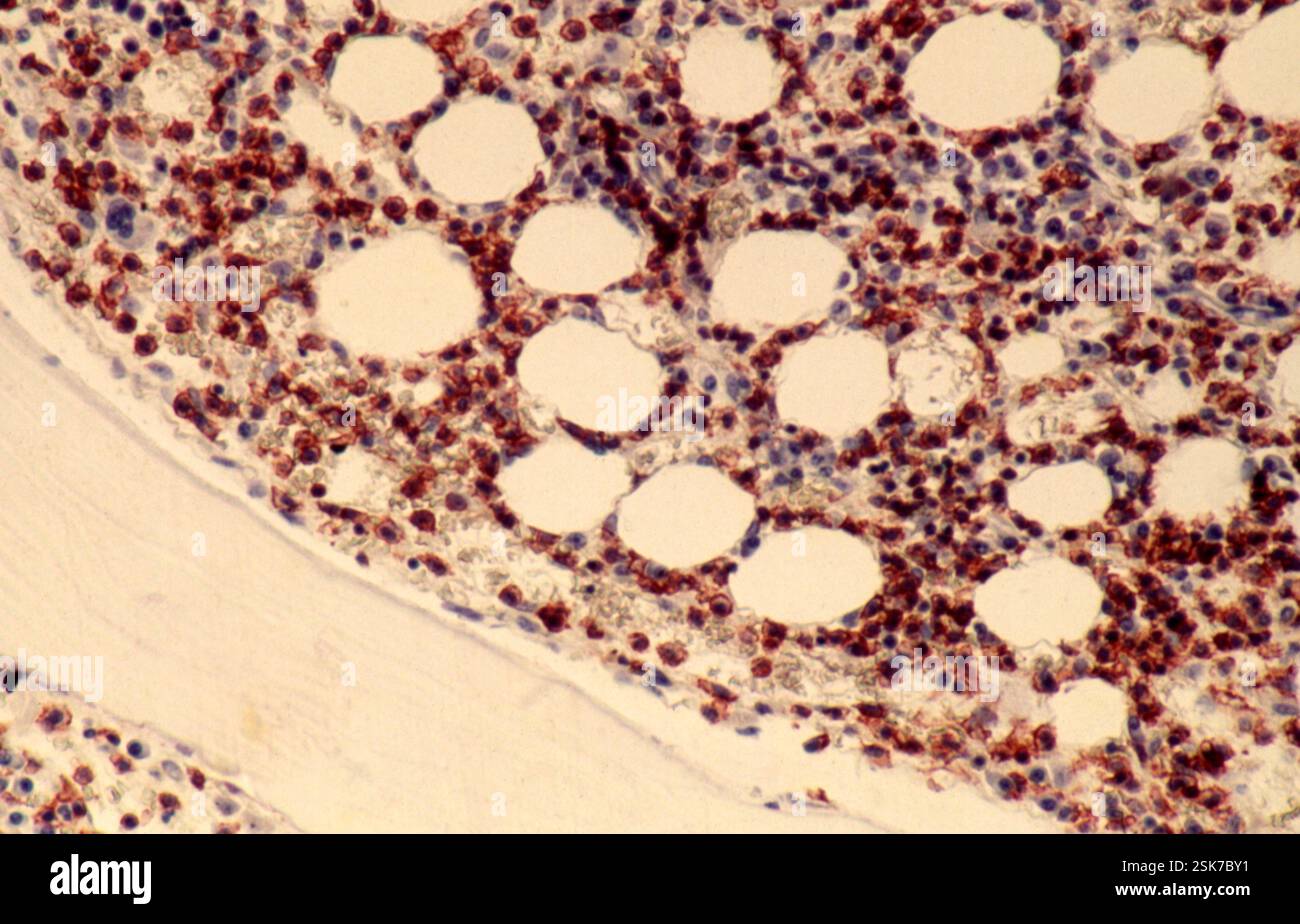 Left ventricular failure, CT scan Stock Photo - Alamy