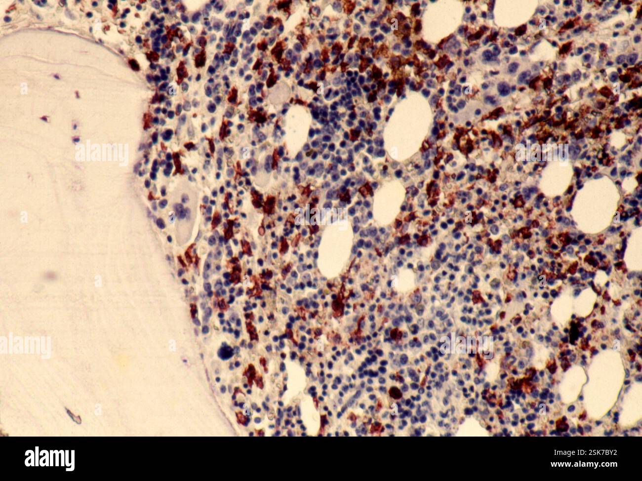 Left ventricular failure, CT scan Stock Photo - Alamy