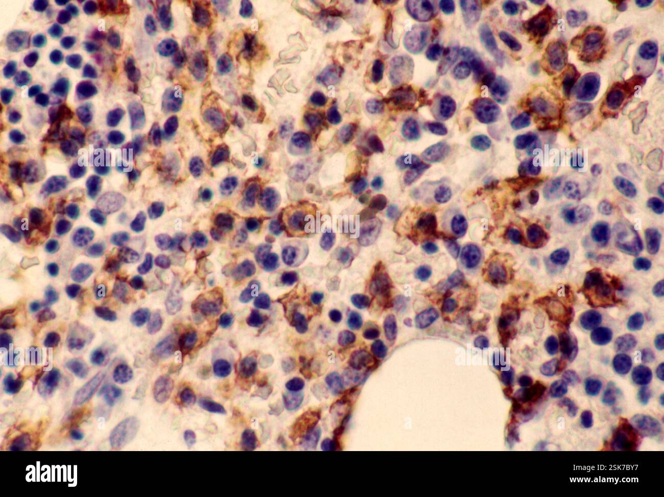 Left ventricular failure, CT scan Stock Photo - Alamy