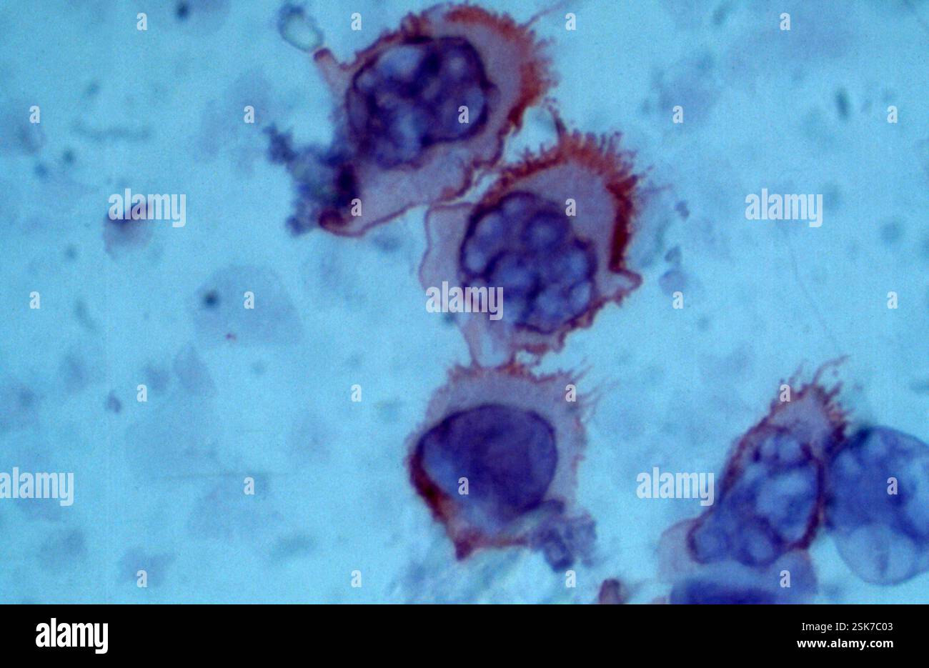 Left ventricular failure, CT scan Stock Photo - Alamy