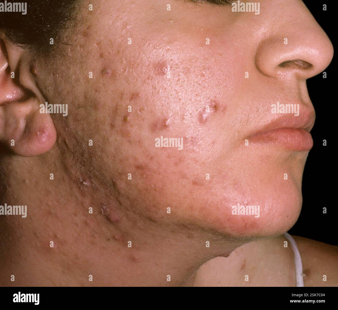 Acne on the face and neck of a 22-year-old man. The small pustules on ...