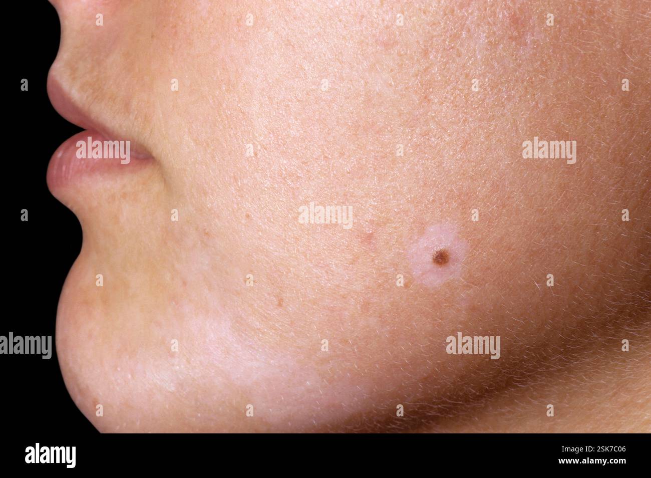 Halo naevus on the cheek of a 15-year-old boy. Also known as a Sutton ...