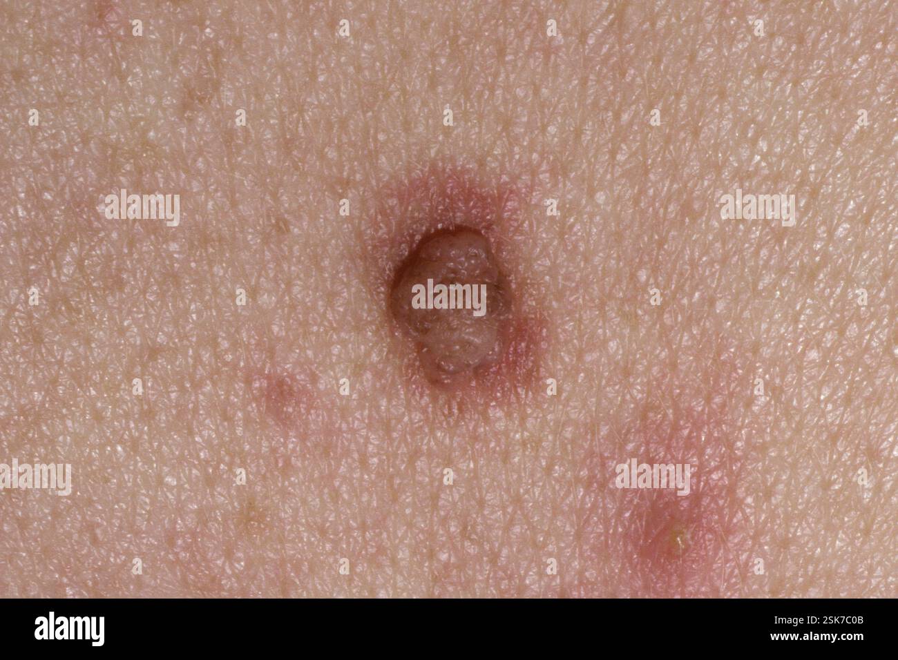 Mole, close-up. This mole is on the skin of a 43-year-old woman. Also ...