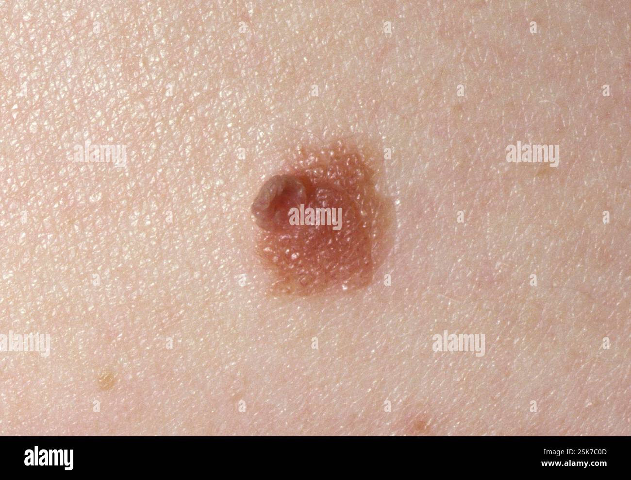 Mole, close-up. This mole is on the skin of a 22-year-old man. Also ...