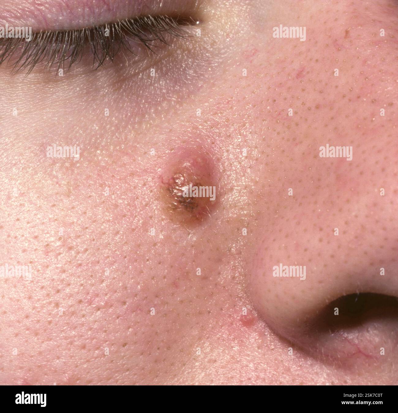 Mole on the cheek of a 25-year-old woman. Also known as a pigmented ...