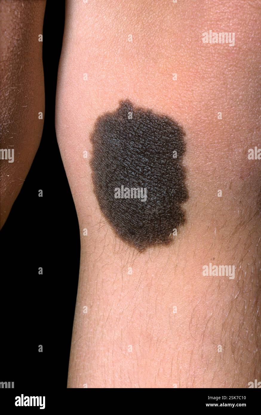 Congenital mole on a leg in a 30-year-old man. Also known as a ...