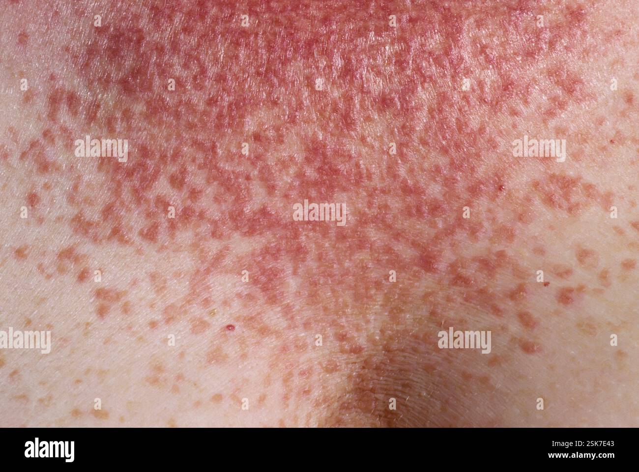 Lutz-Lewandowsky epidermodysplasia verruciformis on the upper chest in ...