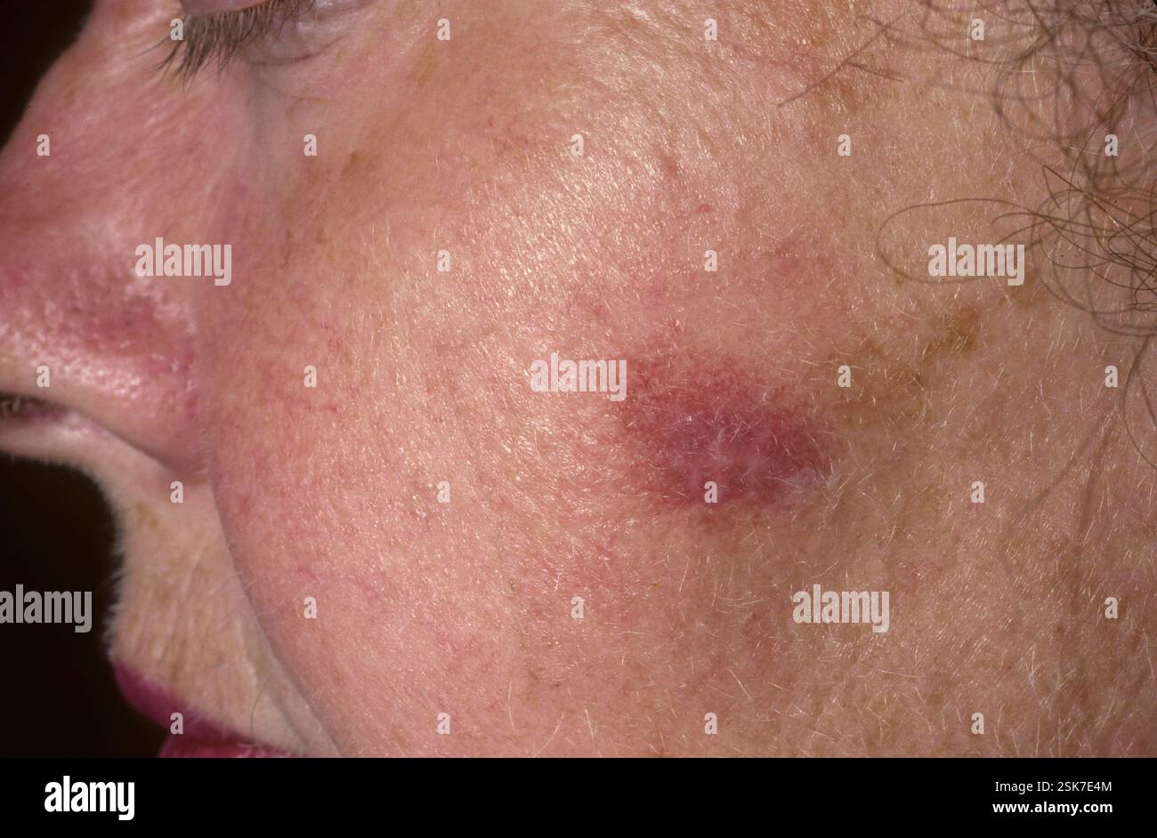 Lever's facial granuloma on the cheek of a 50-year-old woman. A ...