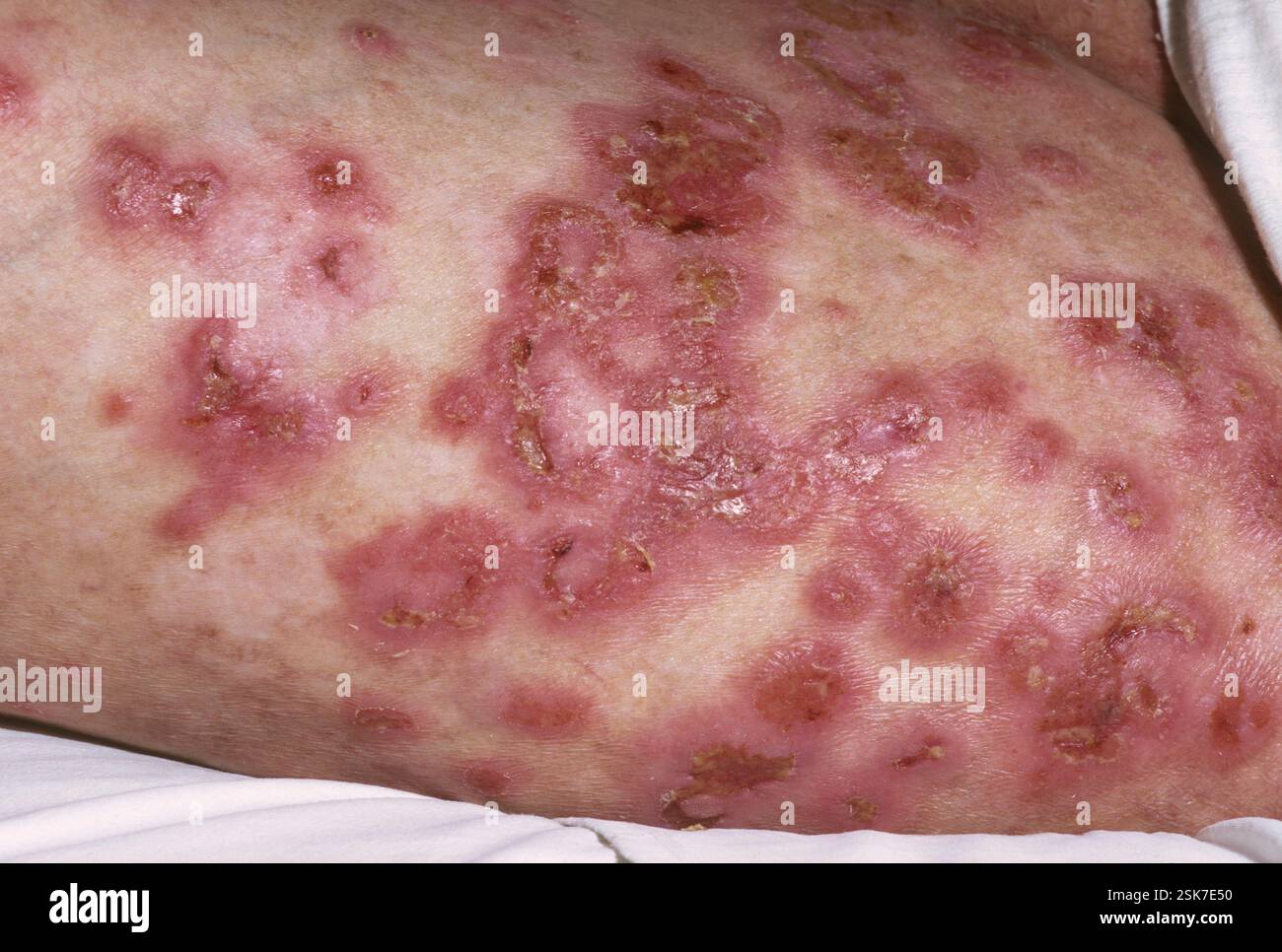 Mycosis fungoides. Close-up of lesions on the skin of a 76-year-old man ...