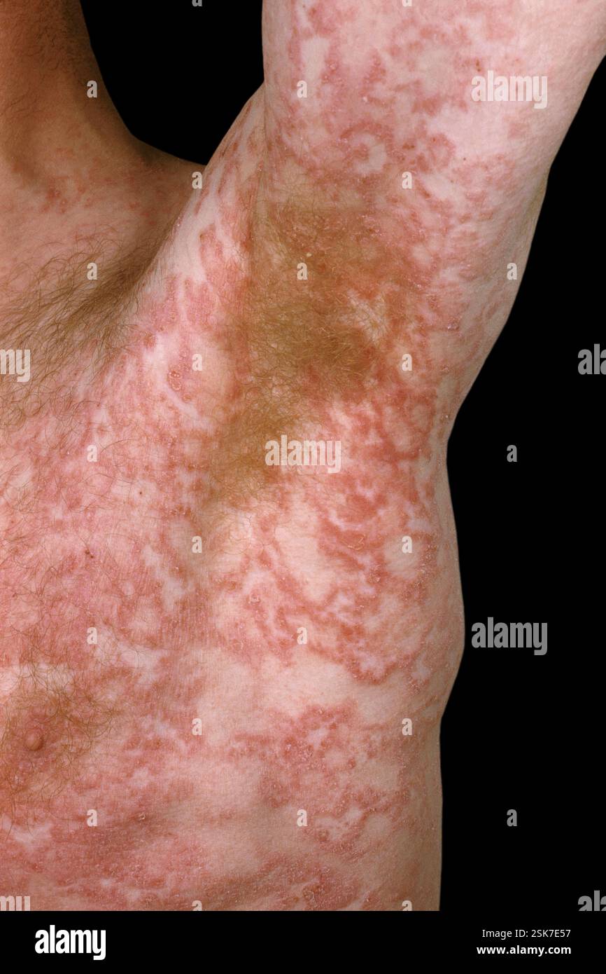 Pellagroid erythema rash (red areas) on the armpit (axilla) and ...