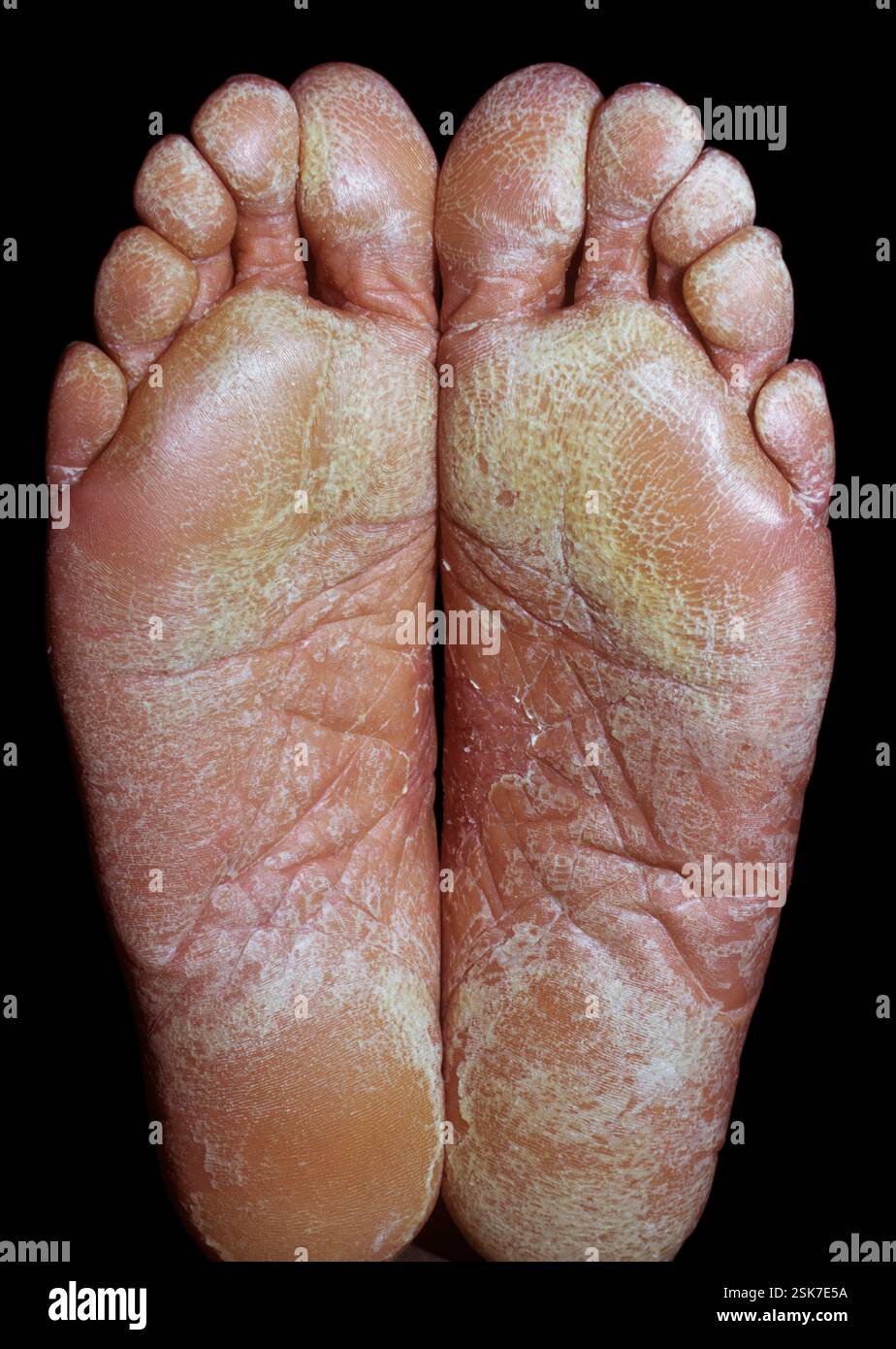 Exfoliative dermatitis of the soles of the feet (plantar erythroderma ...