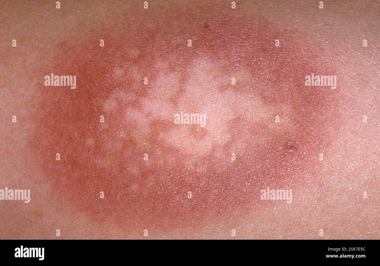 Lesion on skin in fixed drug eruption in a 28-year-old woman. Also ...