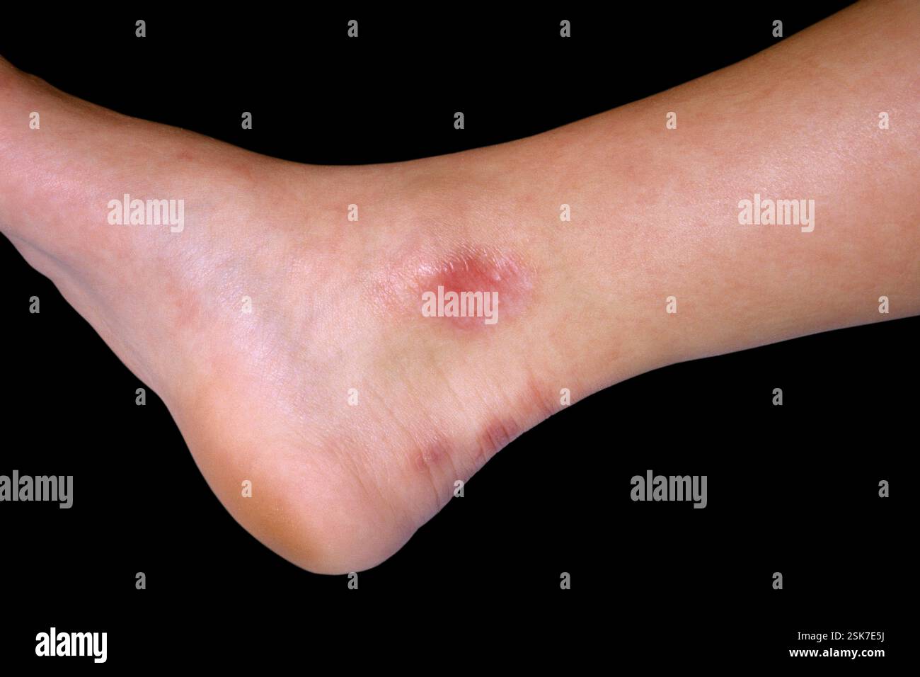 Epidermolysis bullosa (EB) on the ankle of a 20-year-old female patient ...