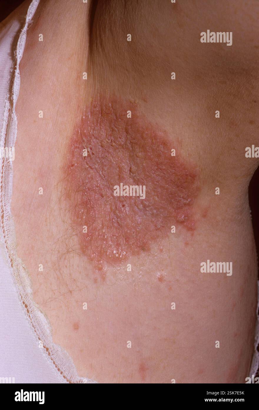 Hailey-Hailey disease. Skin lesion in the left armpit of a 44-year-old ...