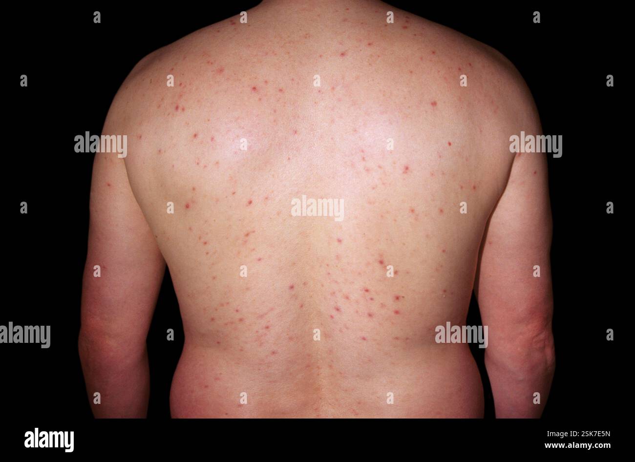 Folliculitis (red skin lesions) on the back of a 46-year-old male ...