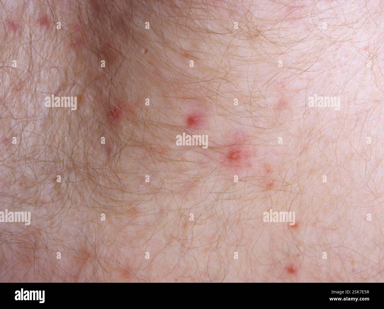 Folliculitis (red skin lesions) in a 36-year-old male patient ...