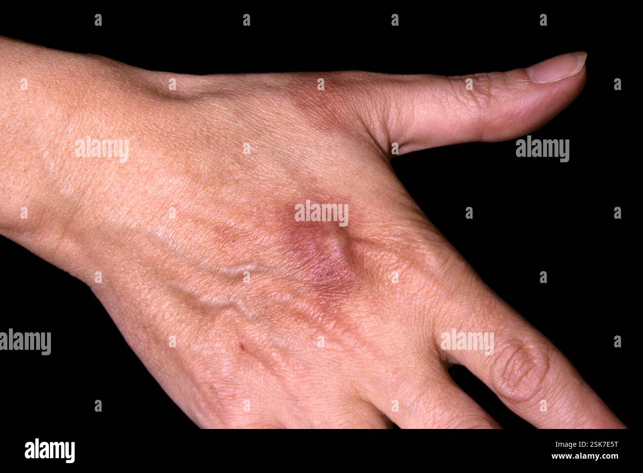 Lesion on hand in fixed drug eruption in a 59-year-old female patient ...