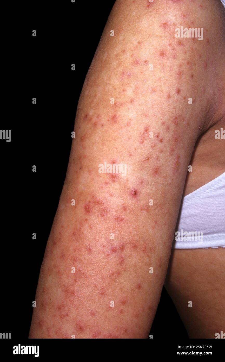 Folliculitis (red skin lesions) on the arm of a 25-year-old female ...