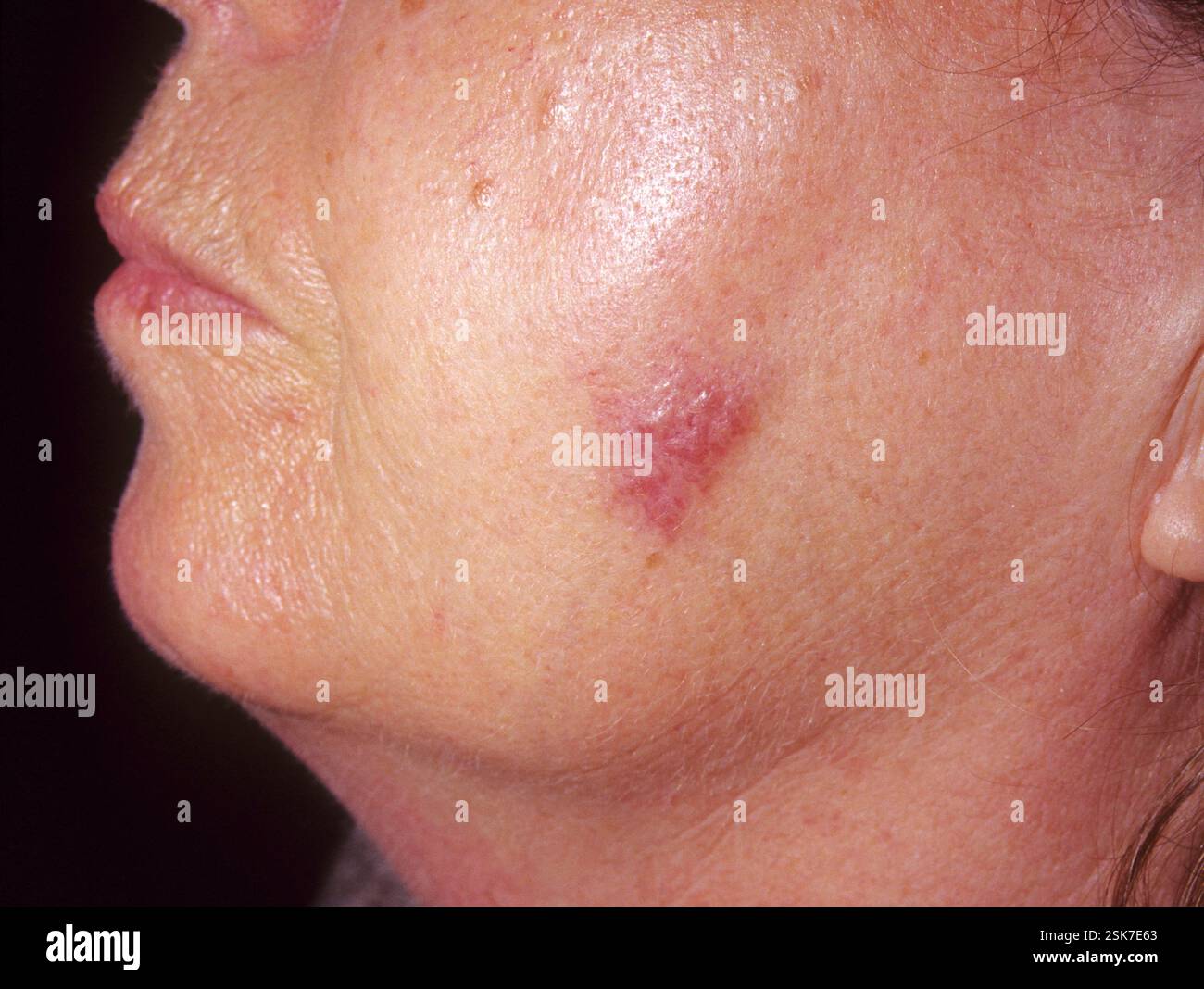 Benign lymphocytic infiltrate of the skin on the cheek of a 72-year-old ...