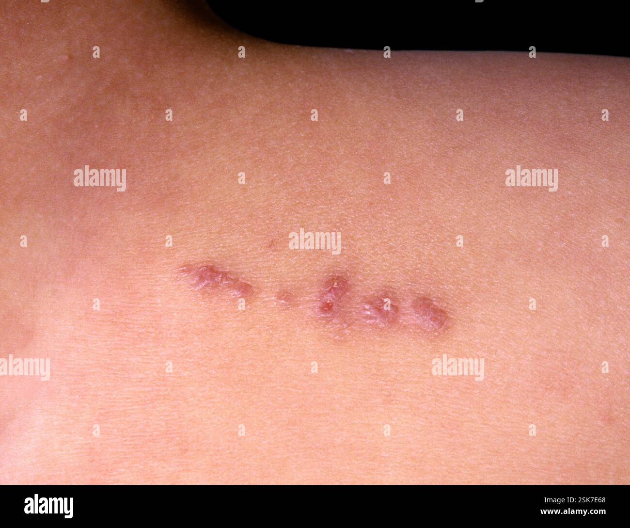 Cutaneous lymphangioma on the shoulder of a 15-year-old teenage boy ...