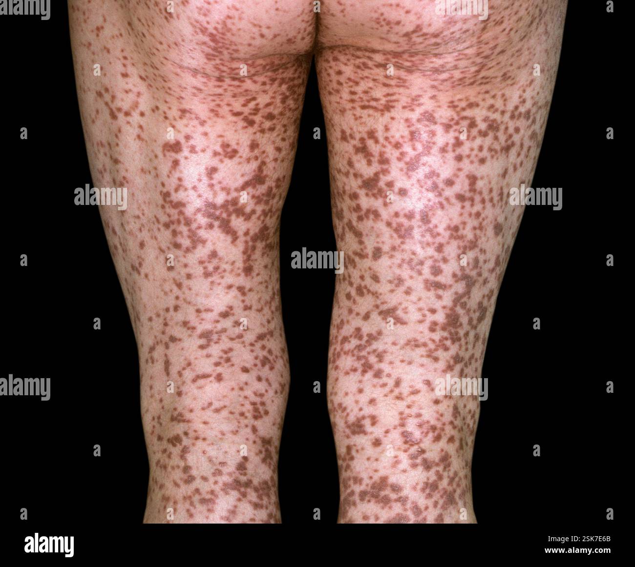 Diffuse cutaneous mastocytosis (urticaria pigmentosa) on the lower ...