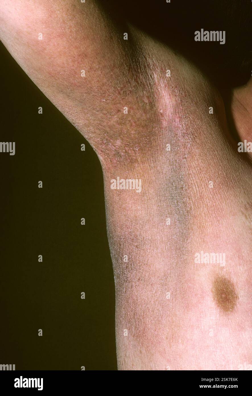 Parapsoriasis lichenoides skin lesion in the right armpit of a 36-year ...