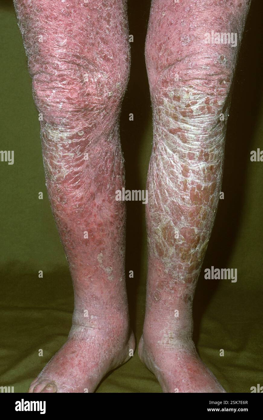 Erythrodermic psoriasis on the legs of a 70-year-old male patient ...