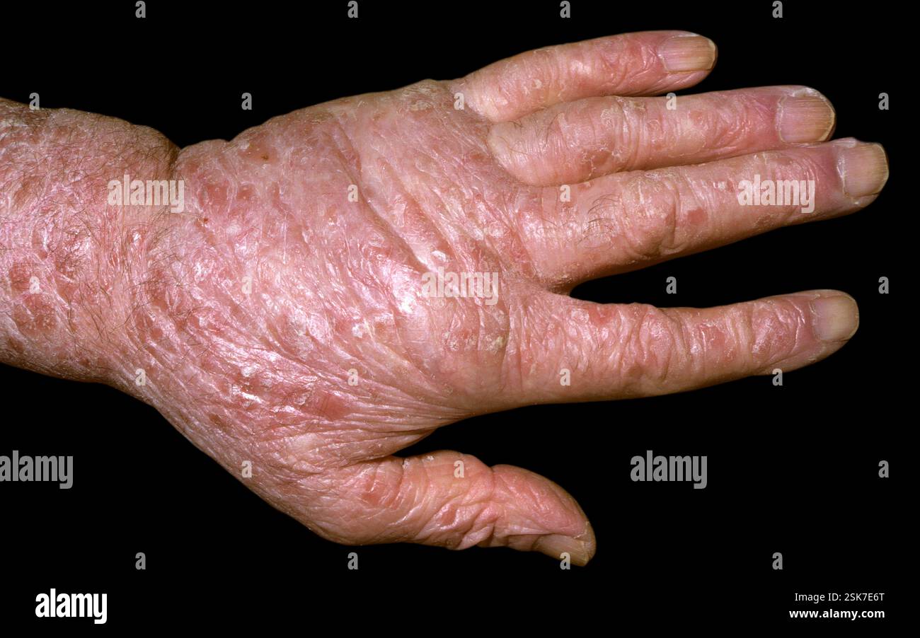 Erythrodermic psoriasis on the hand of a 70-year-old male patient ...