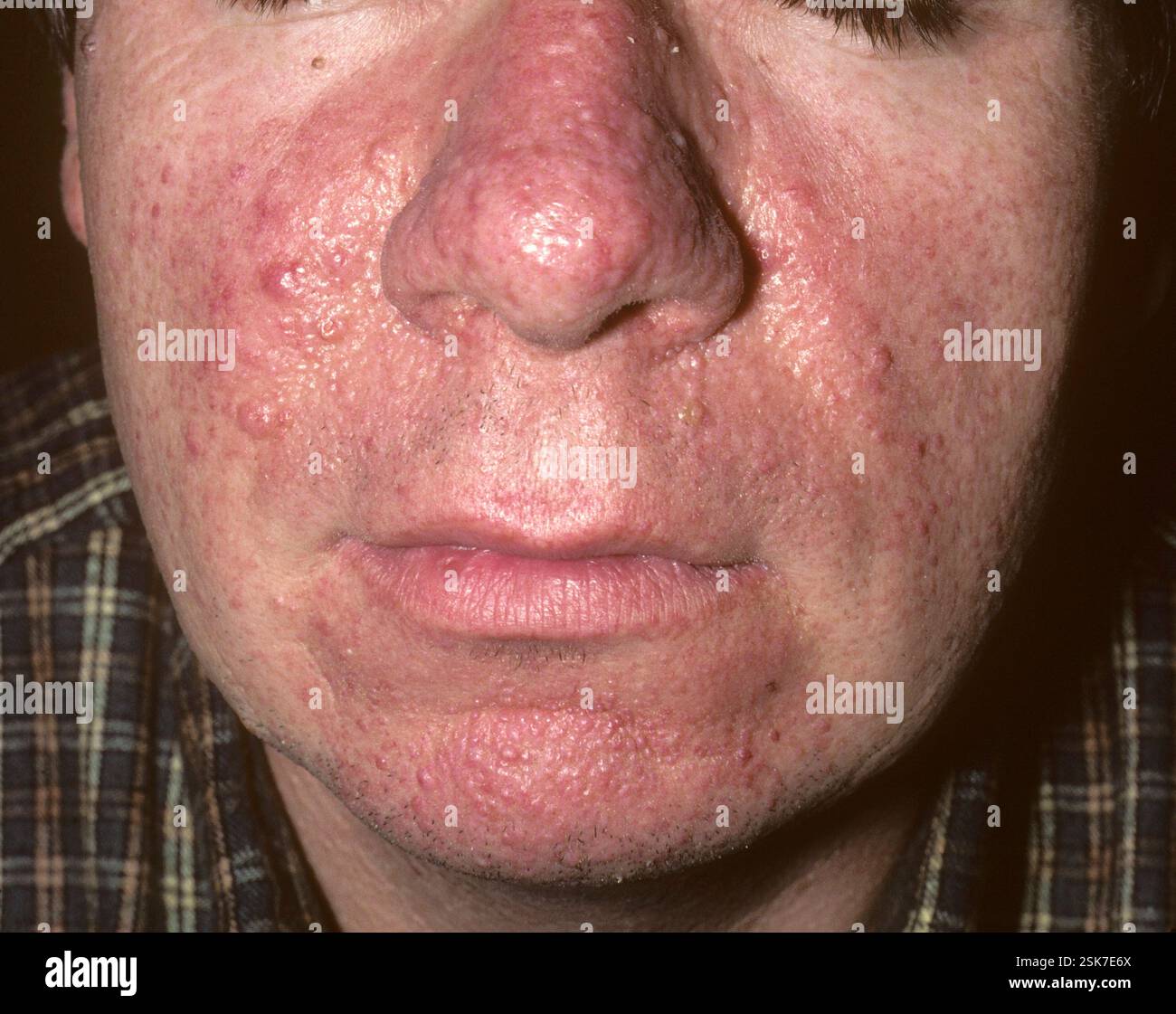 Tuberous sclerosis. Close-up of bumps (cutaneous angiofibromas) on the ...