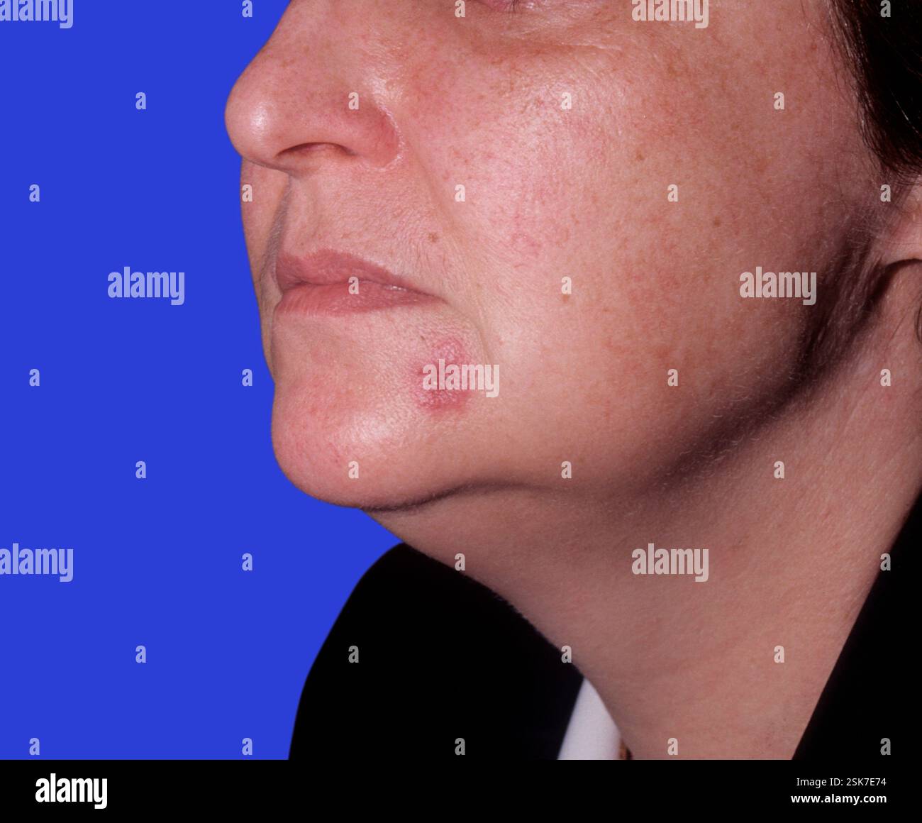 Chronic cutaneous lupus erythematosus (LE) on the face of a 66-year-old ...