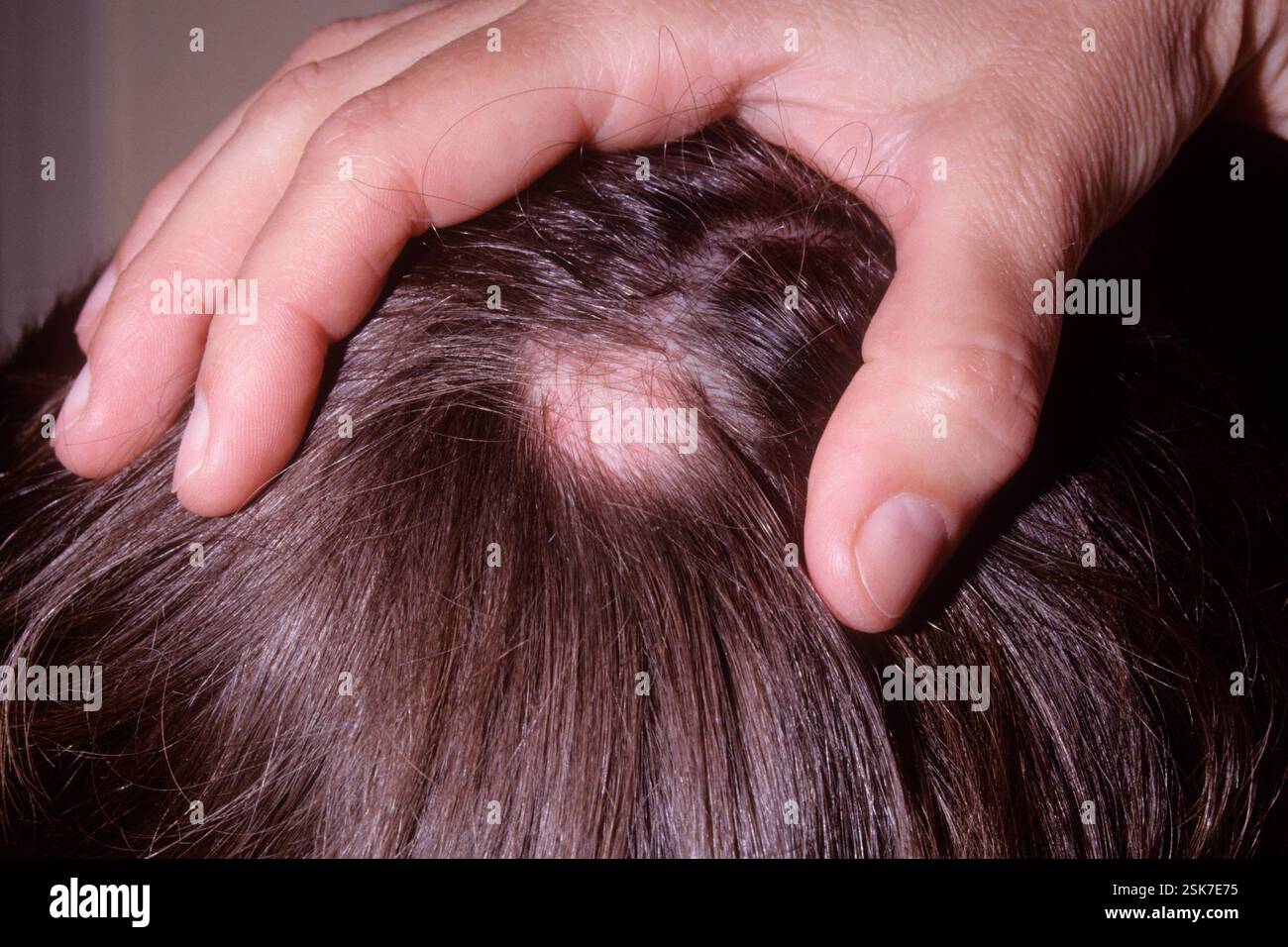 Alopecia (hair loss) on the scalp of a 32-year-old female lupus ...