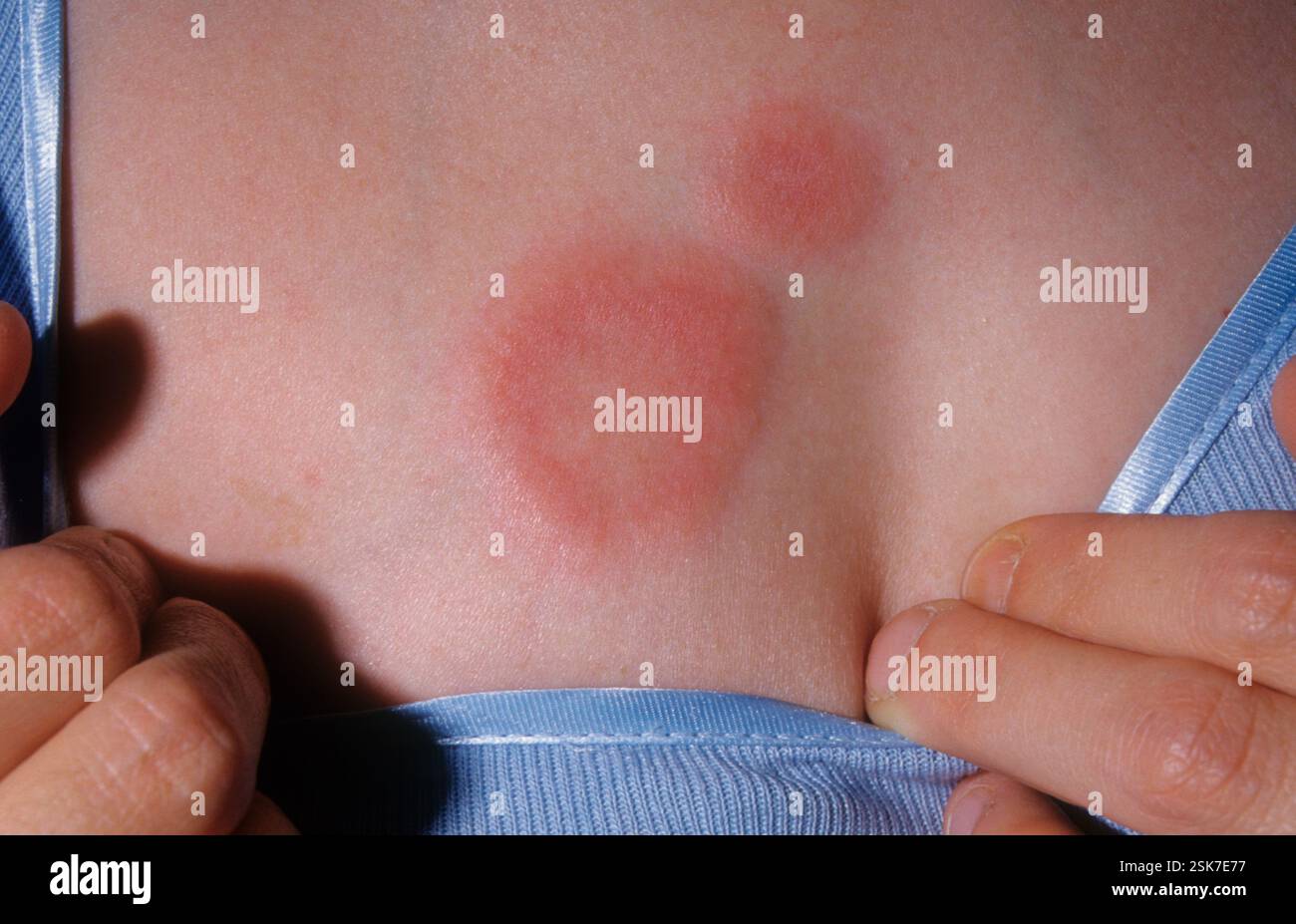 Erythema annulare centrifugum (EAC) on the thorax of a 22-year-old ...