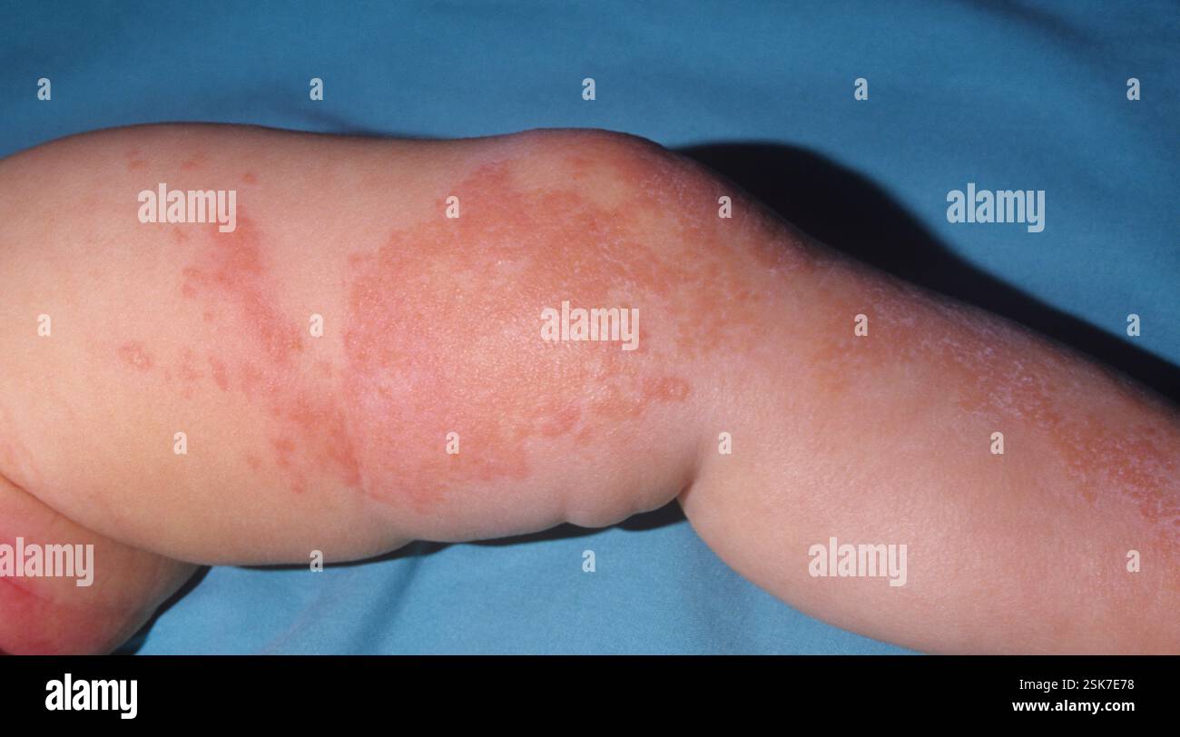 Lichen striatus on the leg of a 5-year-old girl. Lichen striatus is a ...