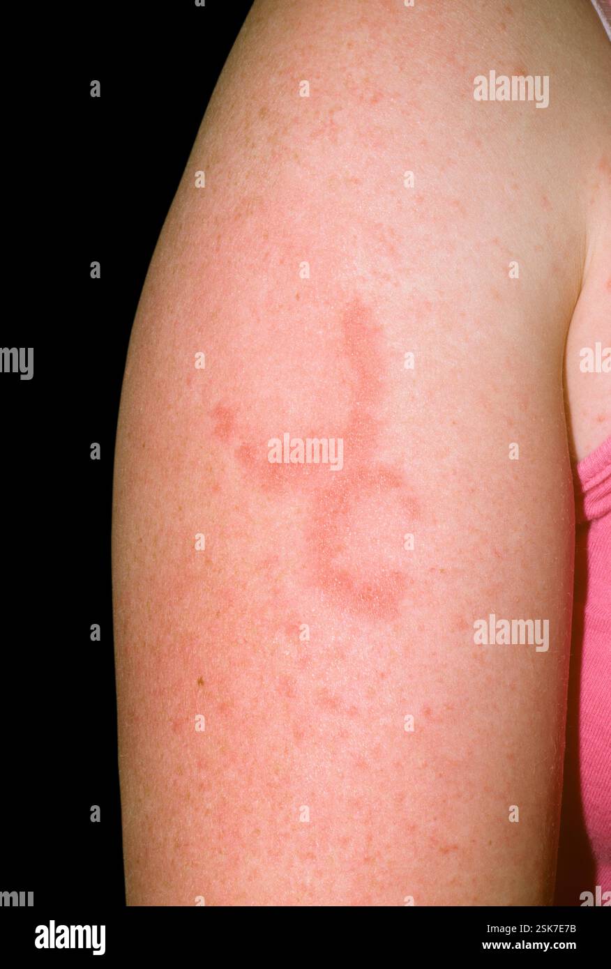 Chronic cutaneous lupus erythematosus (LE) on the arm of a 19-year-old ...