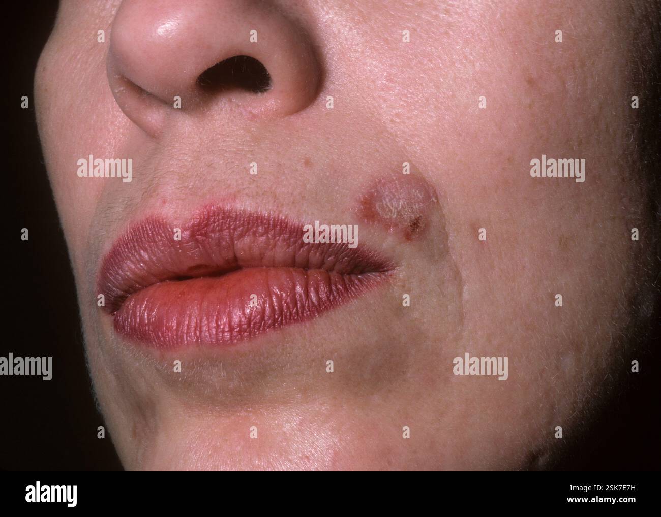 Chronic cutaneous lupus erythematosus (LE) on the face of a 46-year-old ...