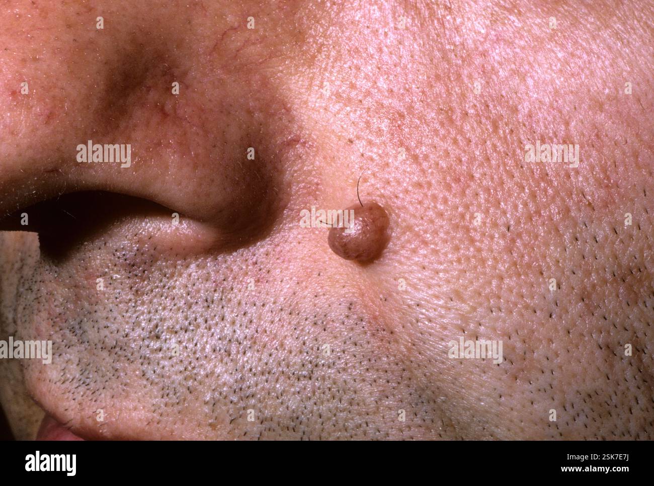 Mole on the cheek of a 60-year-old male patient. Also known as a ...