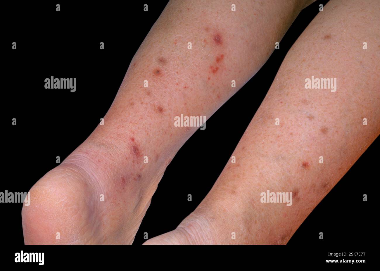 Syphilis chancre on penis Stock Photo - Alamy