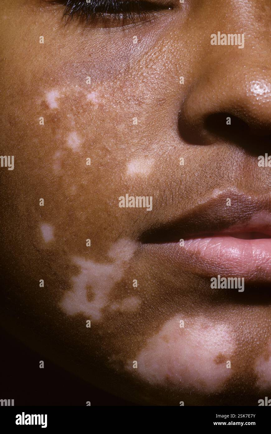 Vitiligo skin patches on the face of a 28-year-old black female patient ...