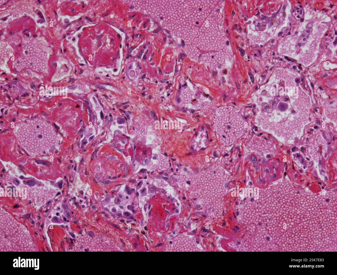 Alveolitis vegetans affecting lung tissue. Light micrograph of a ...