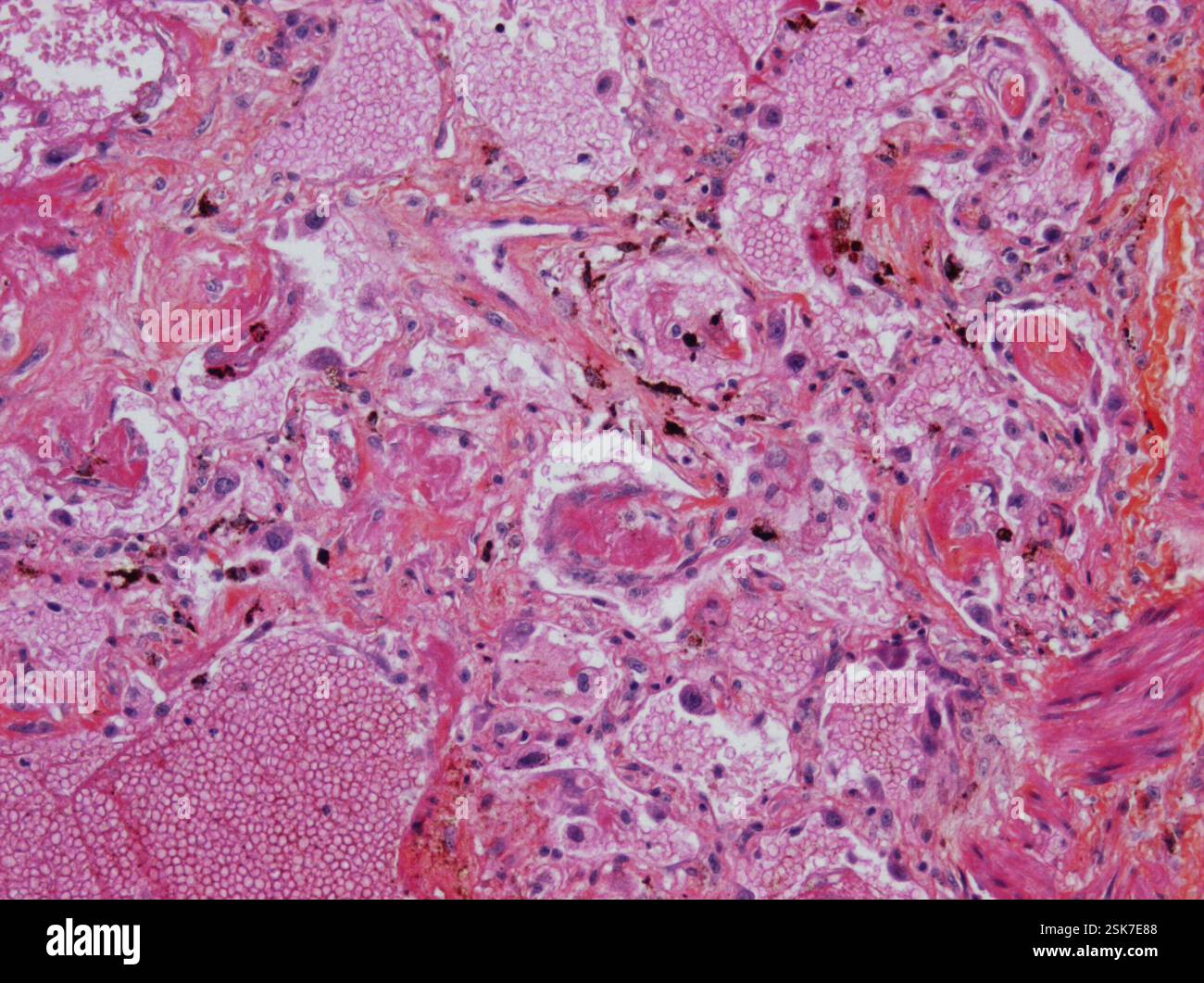 Alveolitis vegetans affecting lung tissue. Light micrograph of a ...