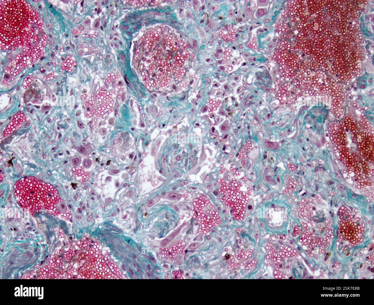 Alveolitis vegetans affecting lung tissue. Light micrograph of a ...