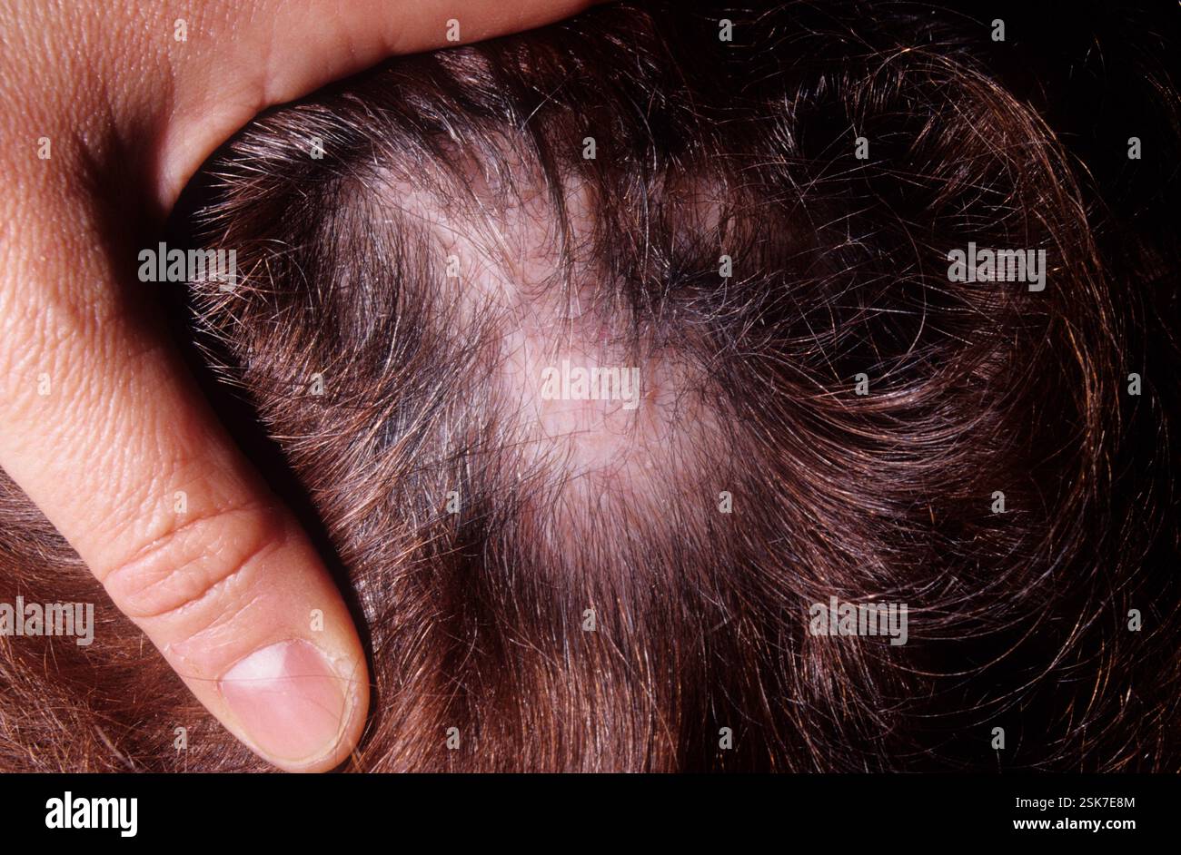 Alopecia (hair loss) on the scalp of a 32-year-old female lupus ...