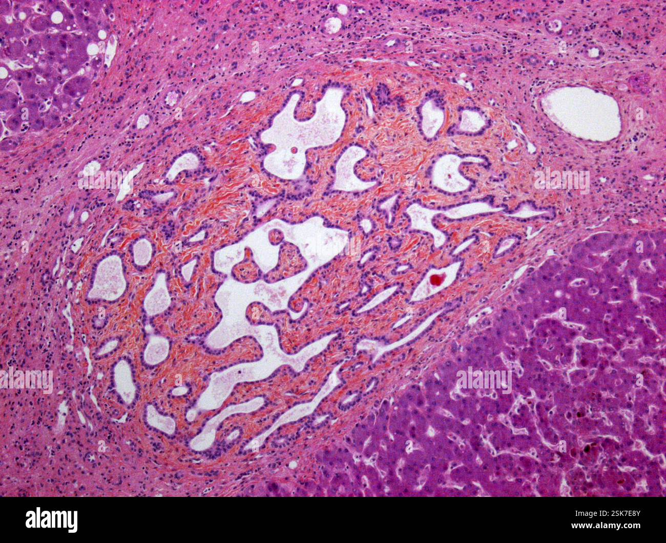 Liver nodule, light micrograph. This liver nodule is a Von Meyenburg ...