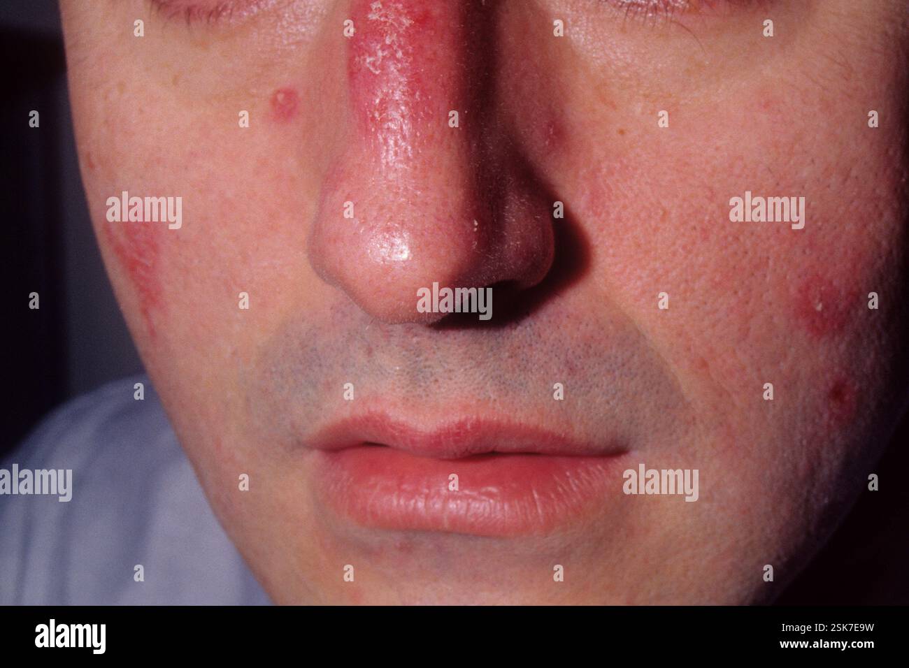 Chronic cutaneous lupus erythematosus (LE) on the face of a 29-year-old ...