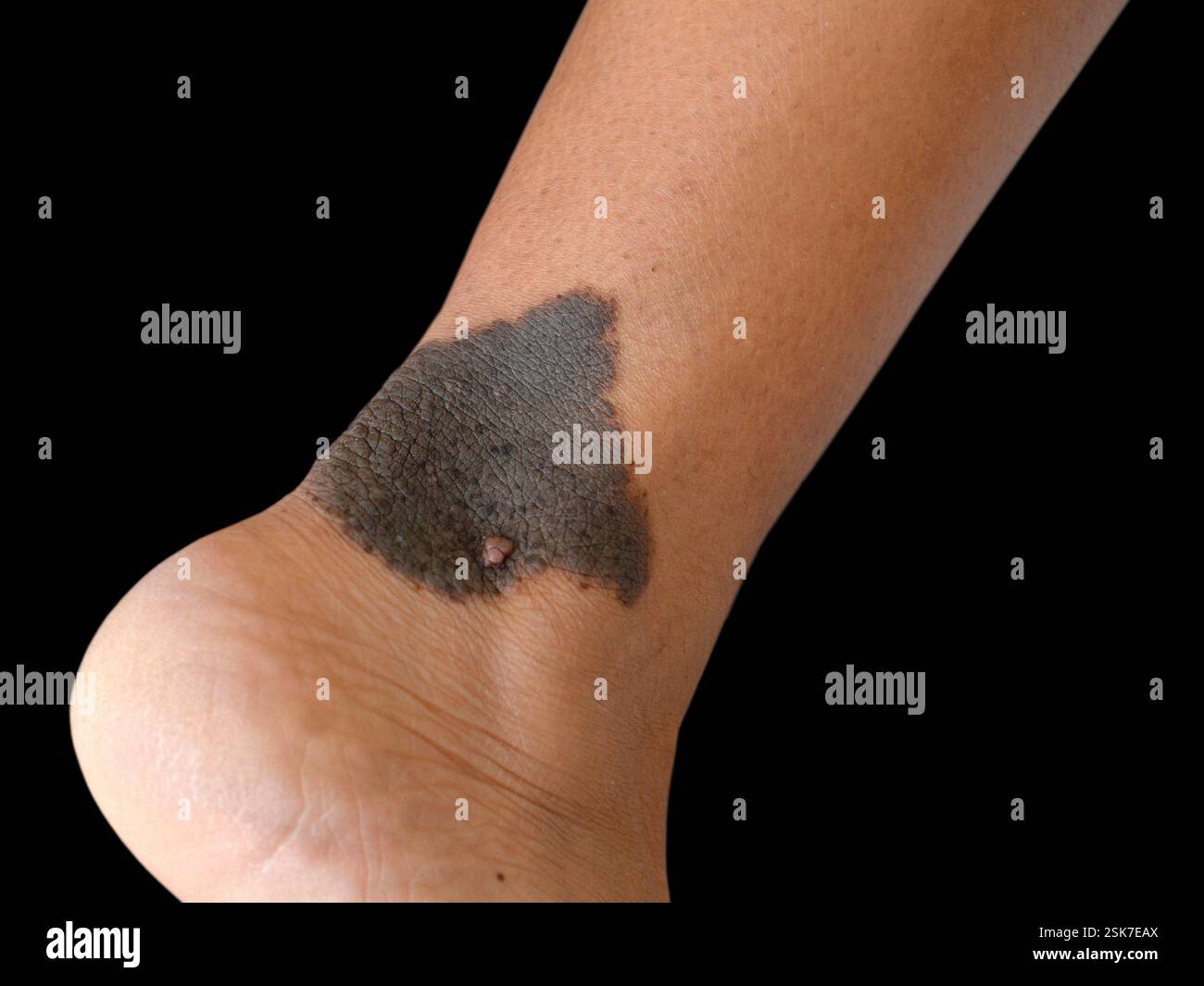 MODEL RELEASED. Congenital mole on a 37-year-old woman's ankle. Also ...