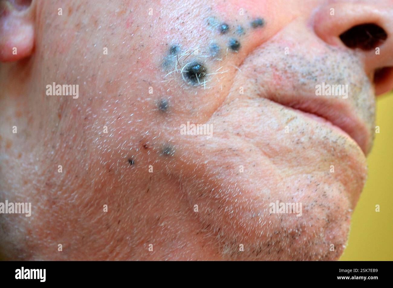 MODEL RELEASED. Cheek affected by metastatic melanoma in an 89-year-old ...