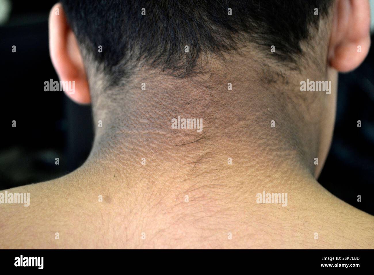 MODEL RELEASED. Acanthosis nigricans. Close-up of skin tags and ...