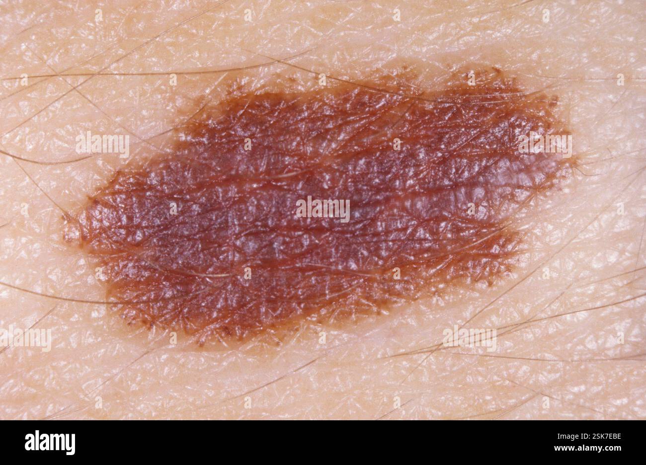 MODEL RELEASED. Mole, close-up. This mole is on a man's skin. Also ...